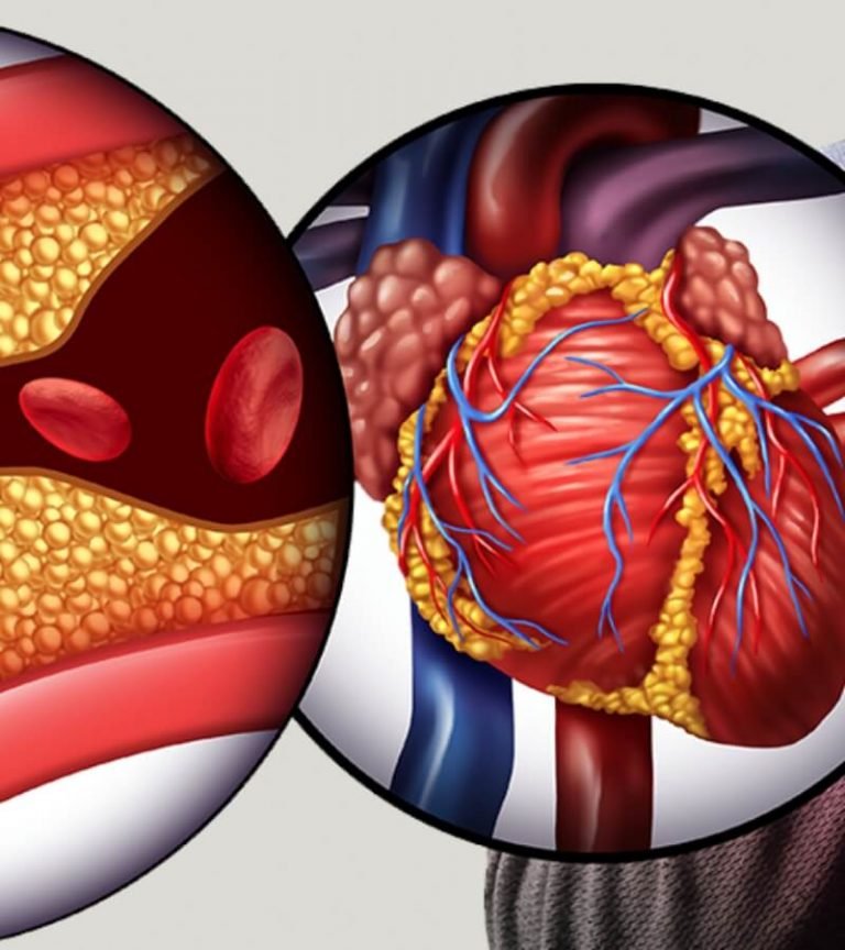 Hiperlipidemias – Dra. Nathalie Carvalho Leite